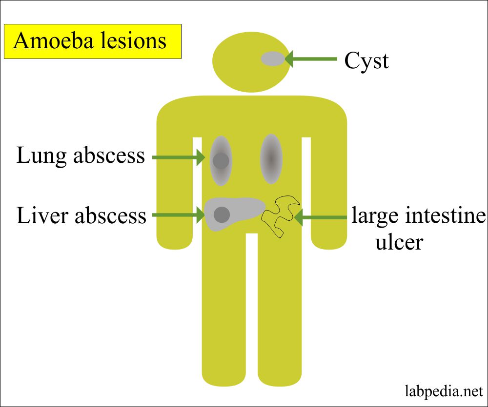 Amebiasis Amoebic Dysentery Entamoeba Histolytica