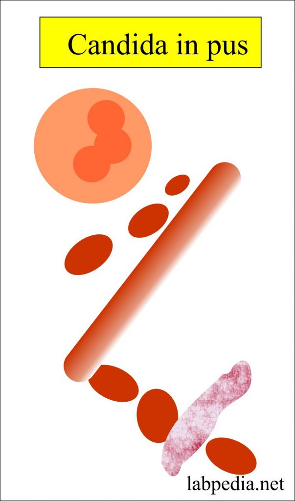 Candidiasis, Candida albicans and Diagnosis – Labpedia.net