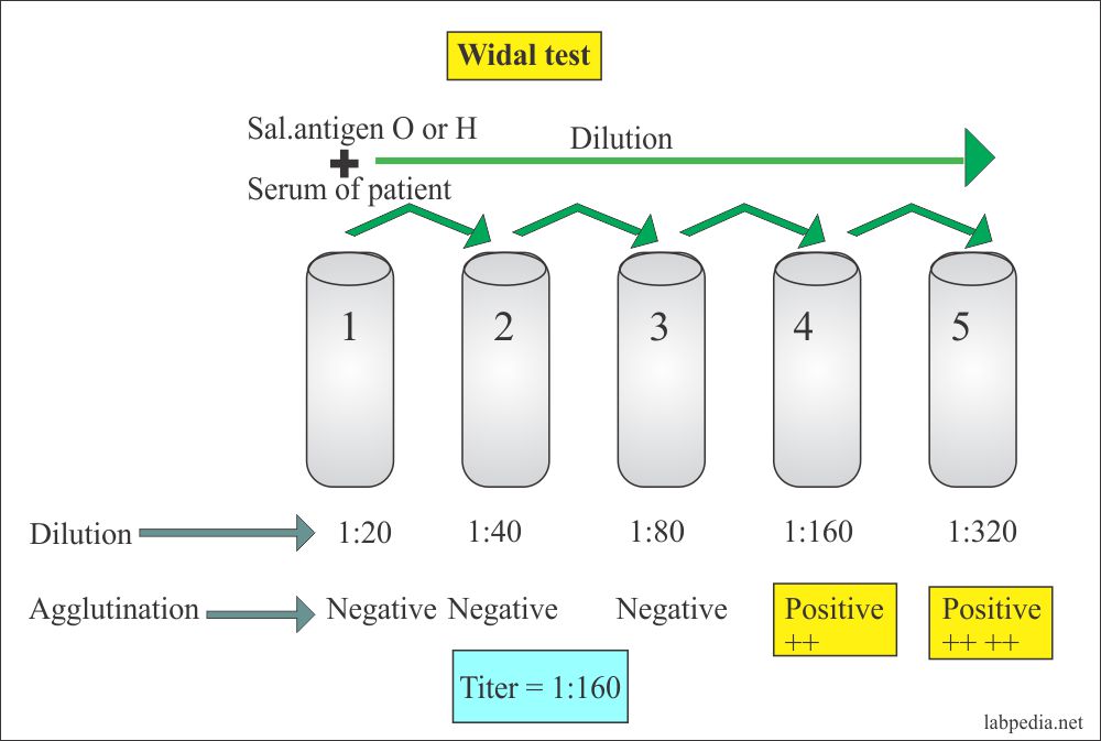 Enteric Fever – Part 1 – Typhoid Fever, Enteric Fever (Salmonella typhi ...