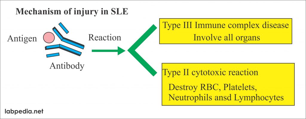 LE cell phenomenon (Lupus erythematosus cell) – Labpedia.net