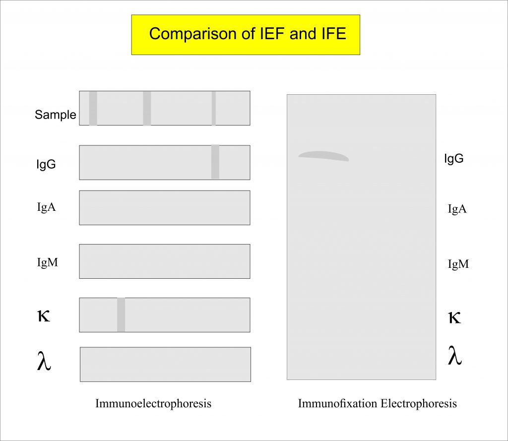 Monoclonal Immunoglobulin (Ig), Monoclonal antibody, Immunofixation ...
