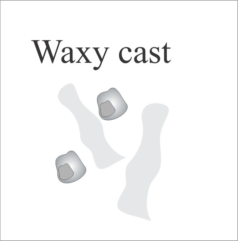 Urine Analysis – part 4 – Microscopic Findings (Urine Microscopy ...