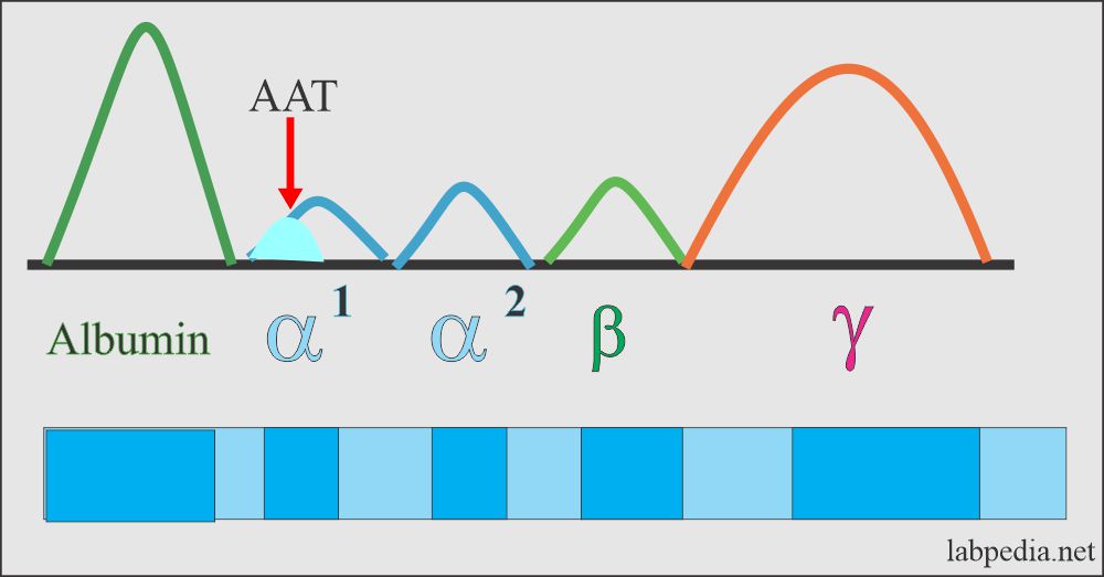 alpha-1-antitrypsin Deficiency, (α1-antitrypsin or AAT Deficiency ...