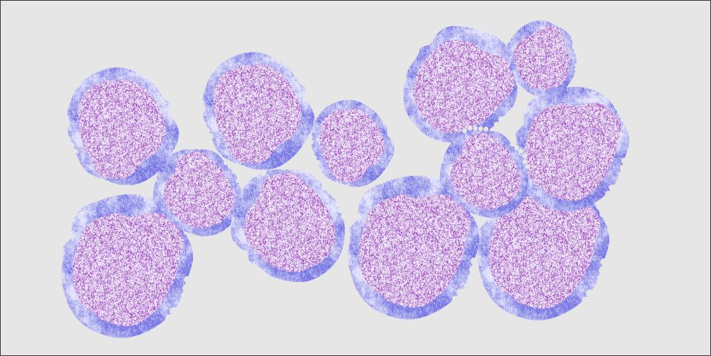 Acute Lymphocytic Anemia – Acute Lymphocytic Leukemia – QNANCK