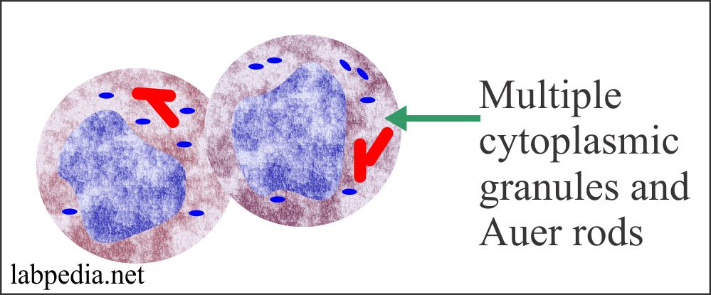 Acute Leukemias and their Diagnosis, Acute Myelocytic and Acute ...