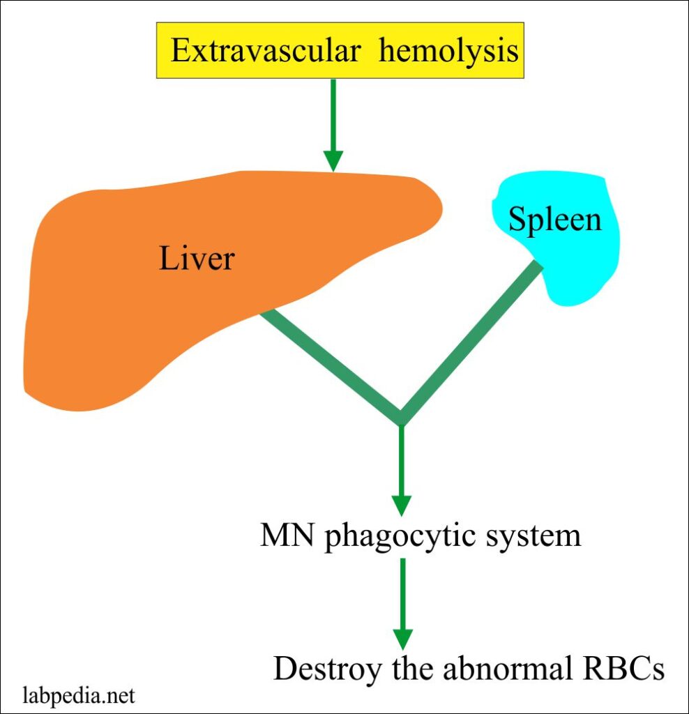 Anemia – Part 6 – Hemolytic Anemias, Causes and Lab Diagnosis ...