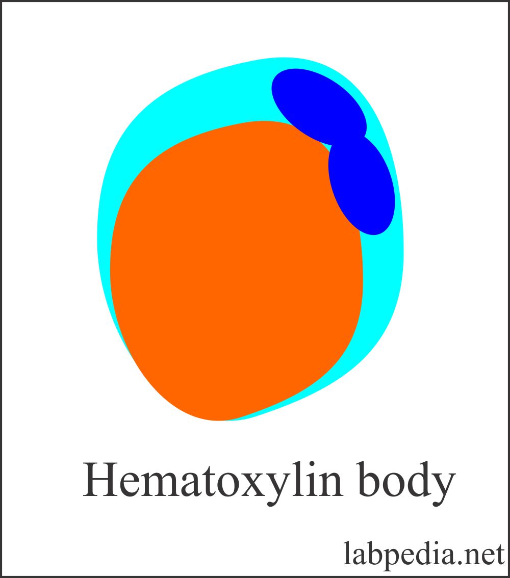 Chapter 17: Autoimmune Diseases, Systemic Lupus erythematosus (SLE ...