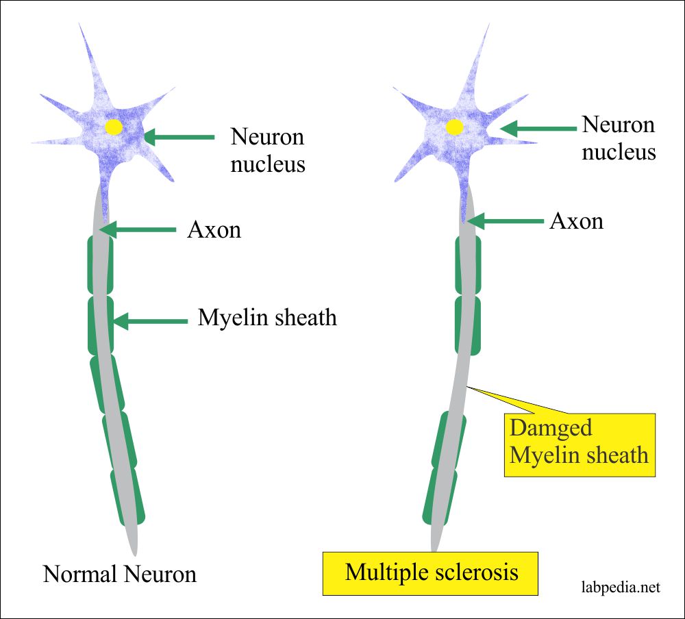 Chapter 26: Multiple Sclerosis (MS) – Labpedia.net